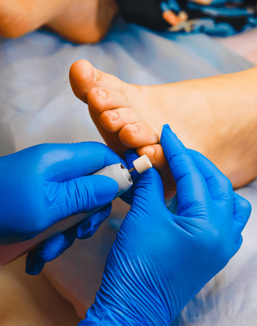 Get Effective Toenail Fungus Treatment - Body Brilliance Med Spa